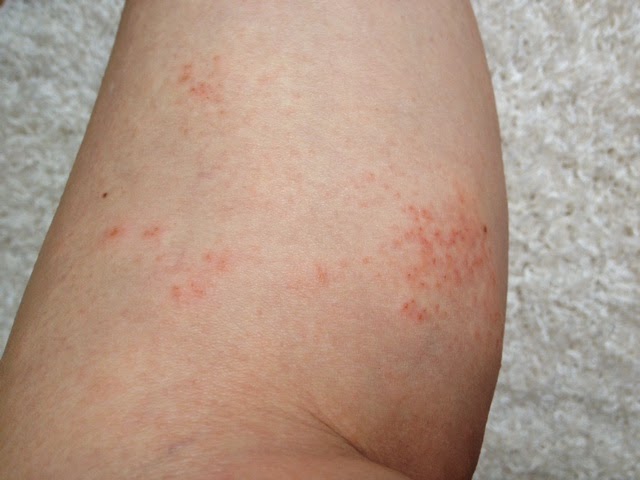 Minä ja sairas elämäni: Haittavaikutus, stafylokokki vai joku muu?