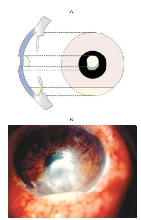 Ophthalmology | Ophthalmologist: Hypopyon corneal ulcer "cornea"