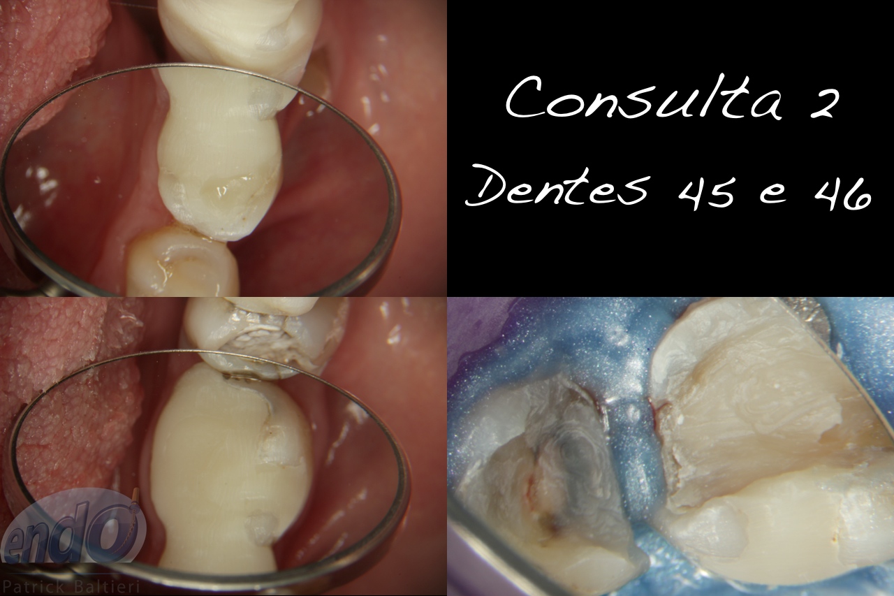 Patrick Baltieri: TRATAMENTO ENDODÔNTICO DOS DENTES 45 - 46 - 47