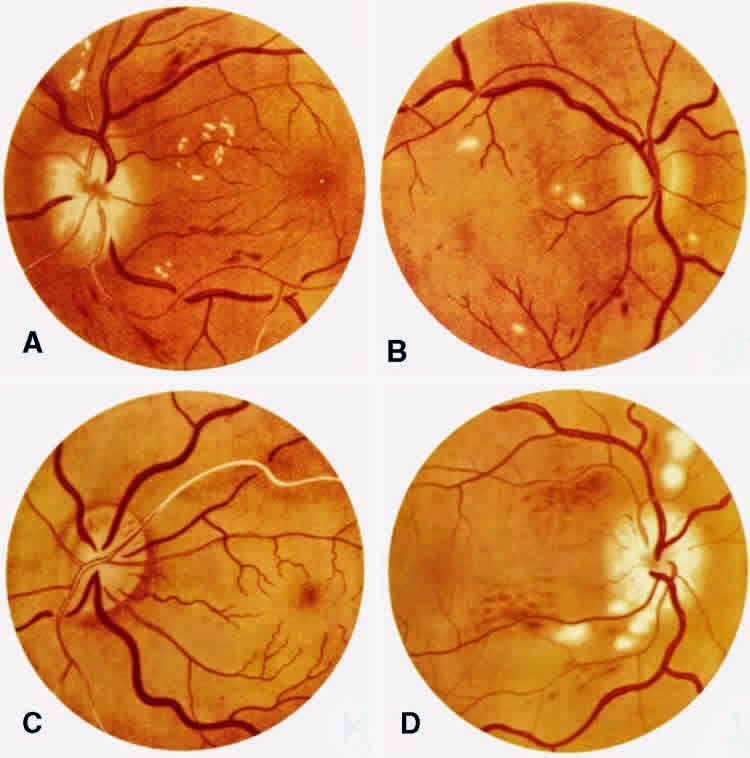 Read It: Retinopati Hipertensi