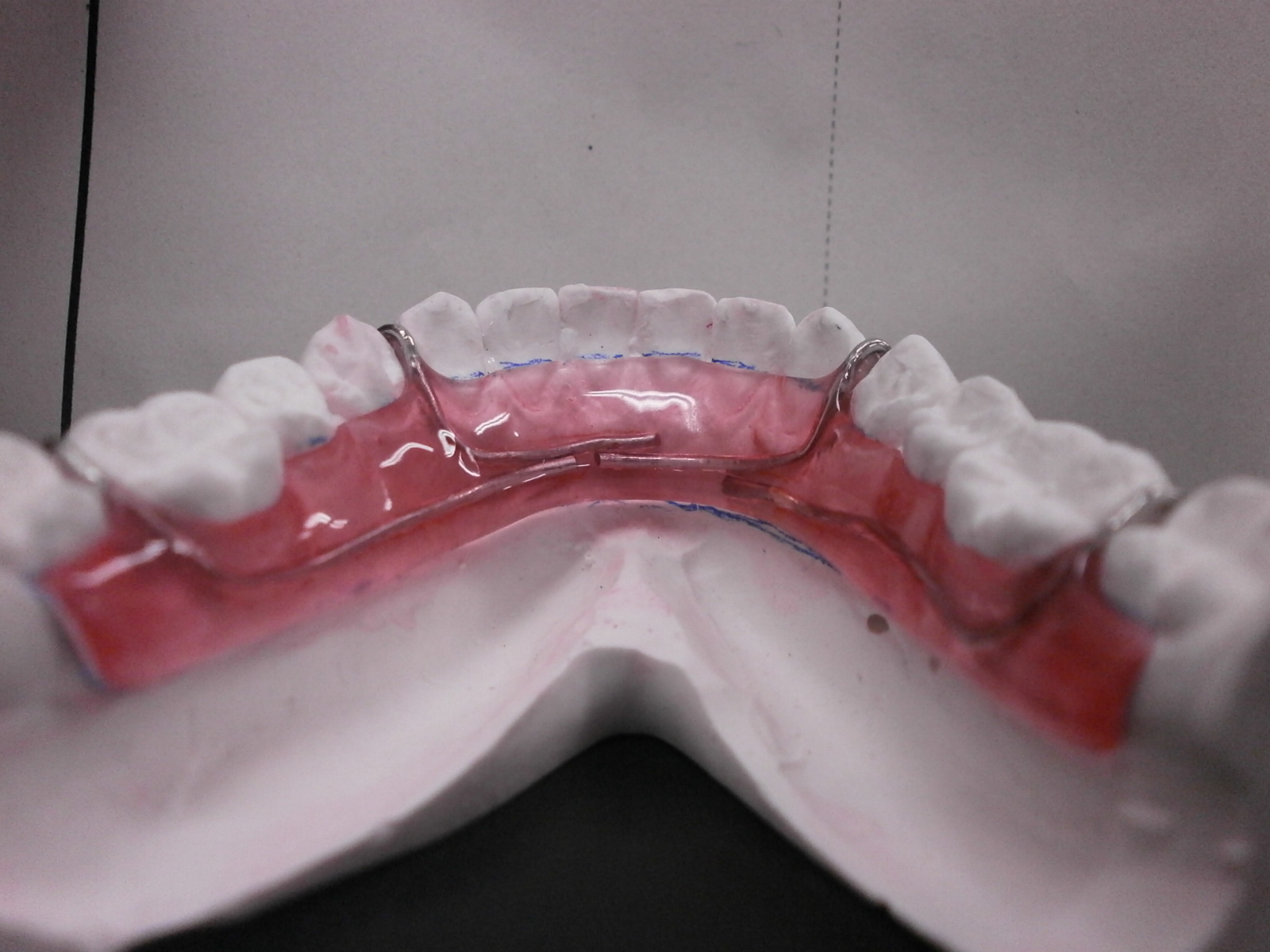髙田朝（Hajime Takada）のオーダーメイド歯科技工物の紹介 Introduction of custom-made dental ...
