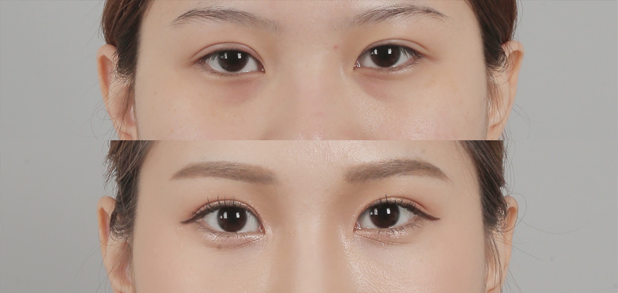 ID Hospital Korea: How to look younger with under eye surgeries