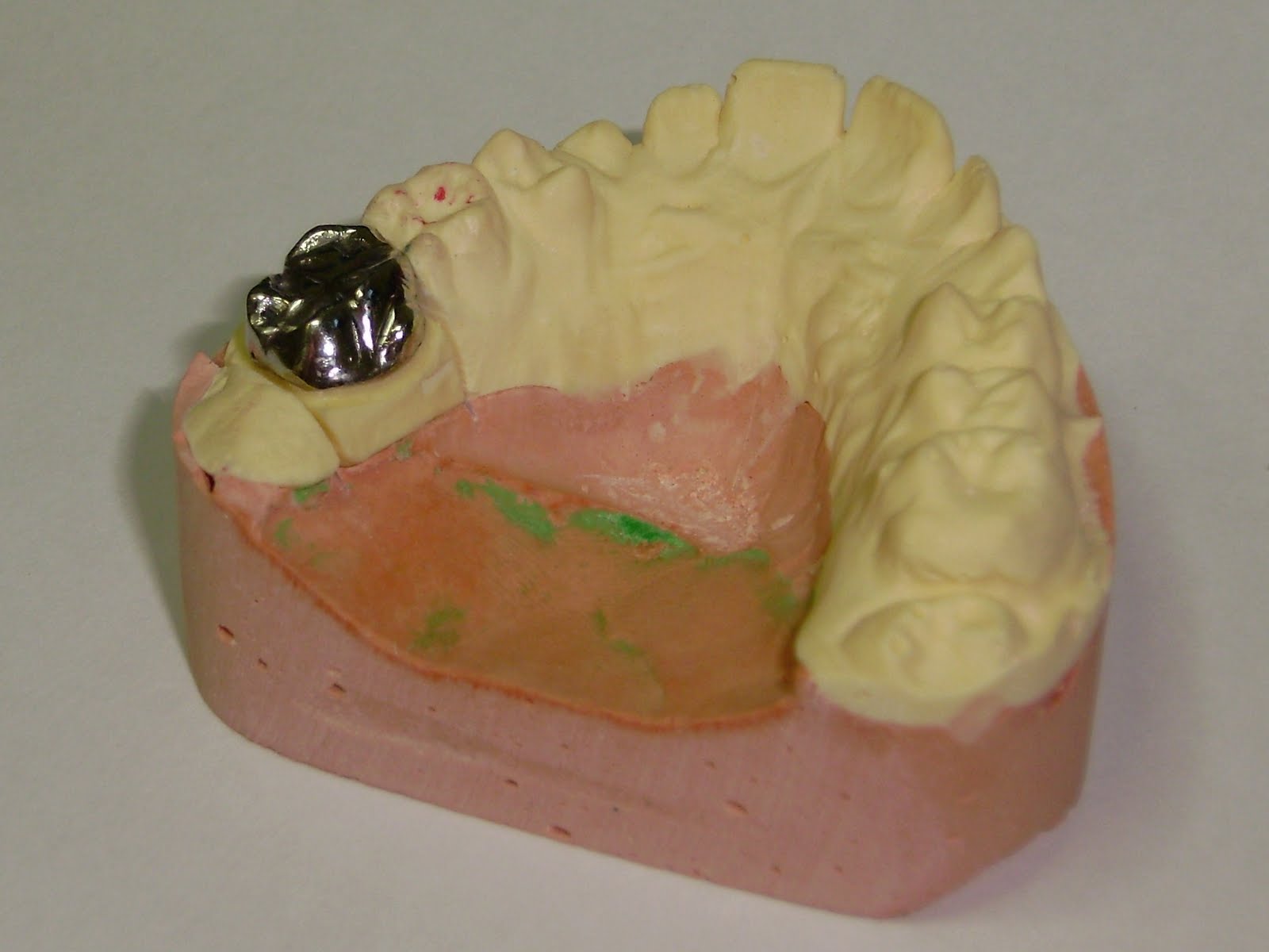 laboratoriodeserafinsalido: CORONAS METAL-PORCELANA