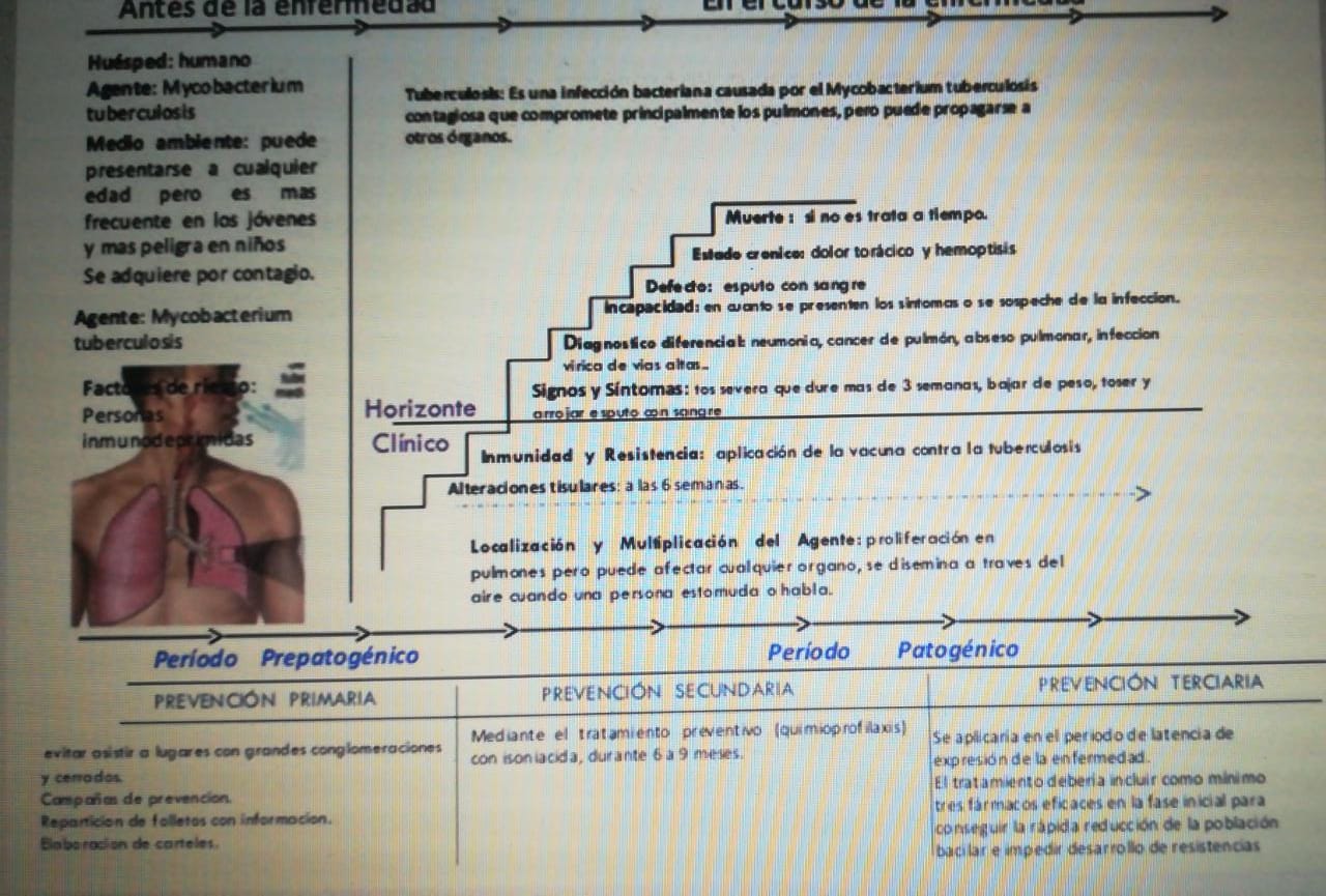 TUBERCULOSIS PULMONAR