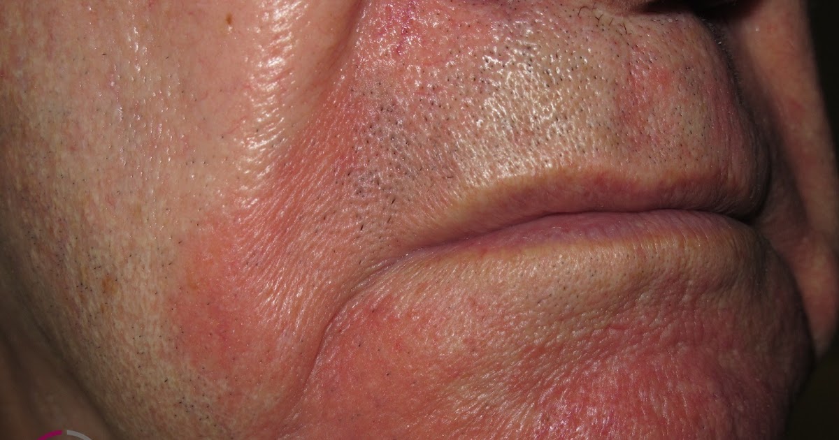 El Diario de Novembre: Brote de dermatitis facial