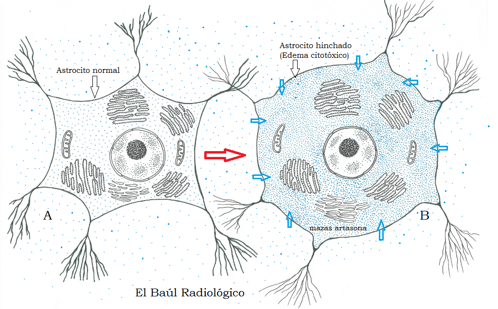 El Baúl Radiológico: 2) EDEMA CITOTÓXICO EN EL SISTEMA NERVIOSO CENTRAL ...