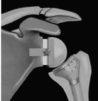 Shoulder Arthritis / Joint Replacement : Reverse total shoulder ...