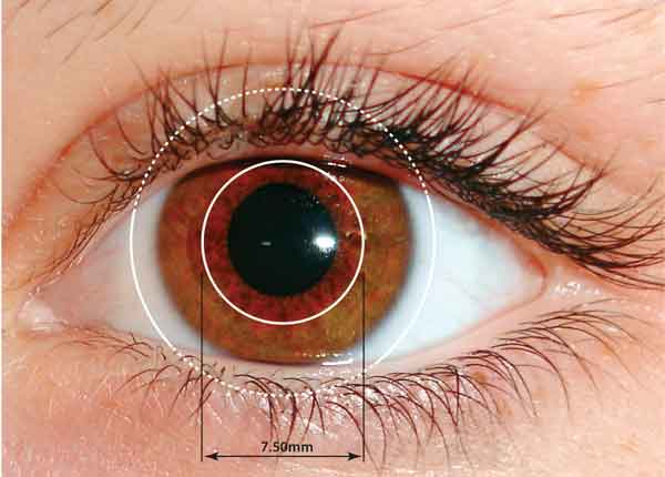 Eye and Cataract Surgery