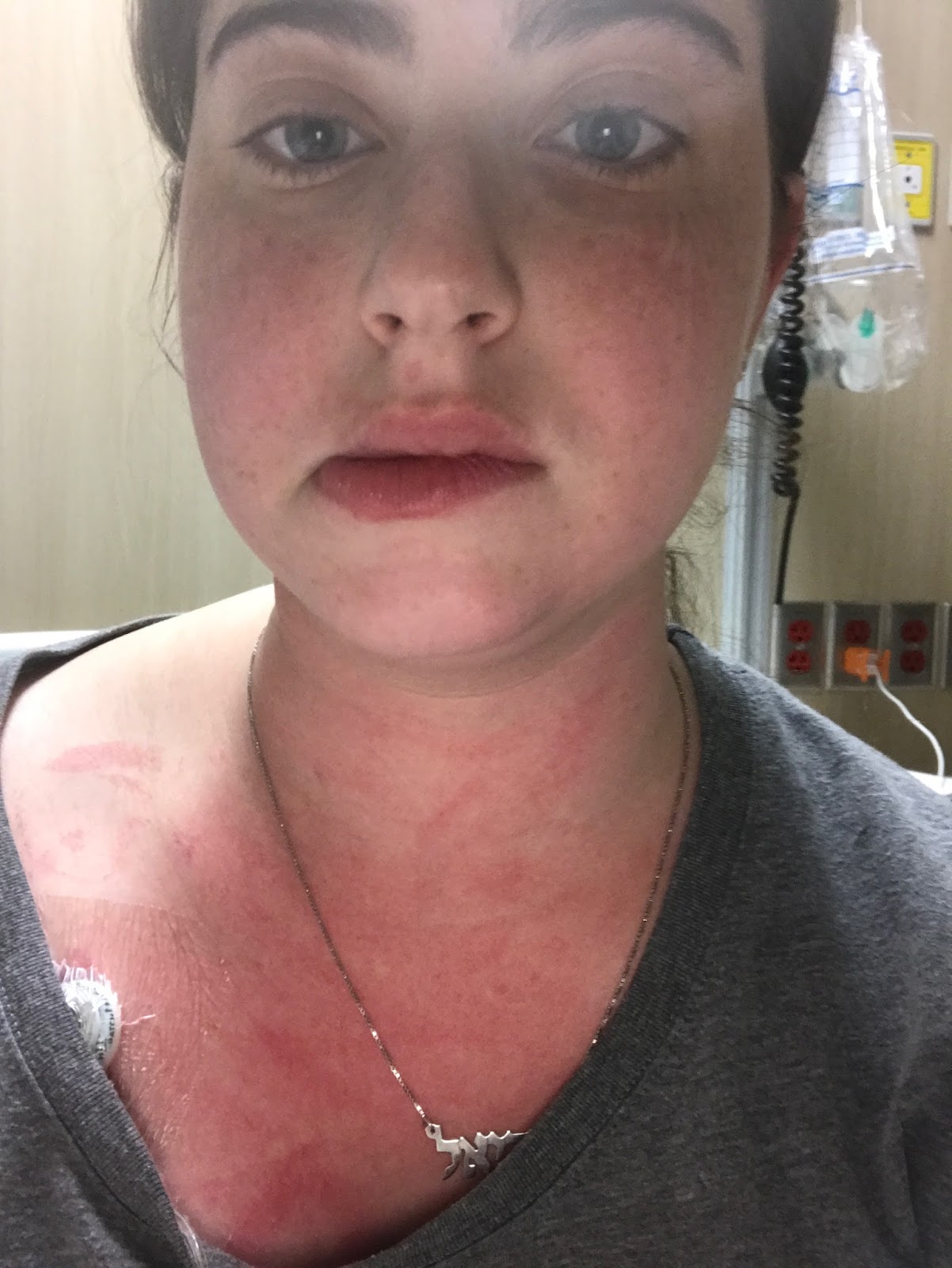 ABCD MCAS what? Arielle's Journey with MCAS, POTS and EDS: April 2017