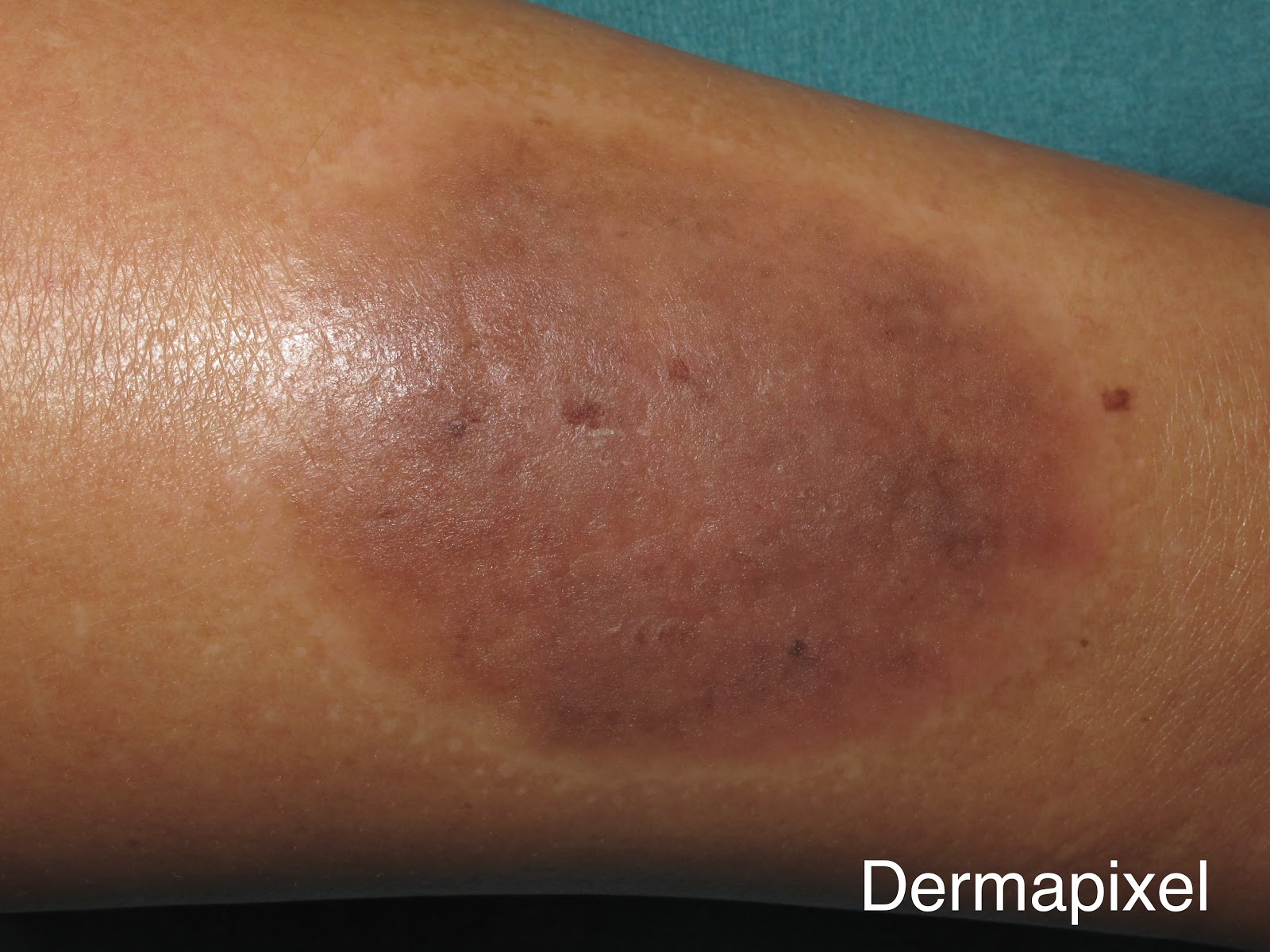 Dermapixel: abril 2018