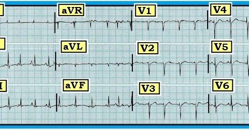 ECG Interpretation: ECG Blog #65 (AFib - RVH - Wandering - MAT)