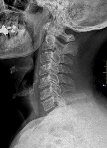 Radiologia: Aprenda bater radiografia do Coluna Cervical AP ou PA e Perfil