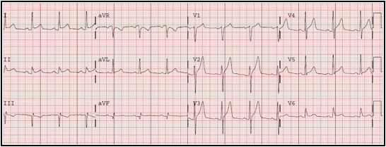 ECG Class - Keeping ECGs Simple: Different Patterns Of ST Elevation