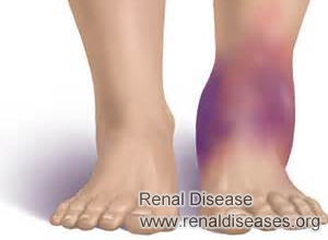 Kidney-Disease-Health: What is the cause of edema of nephrotic syndrome?