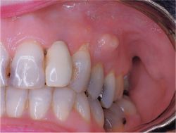 Periodontitis Information: Acute Apical Periodontitis