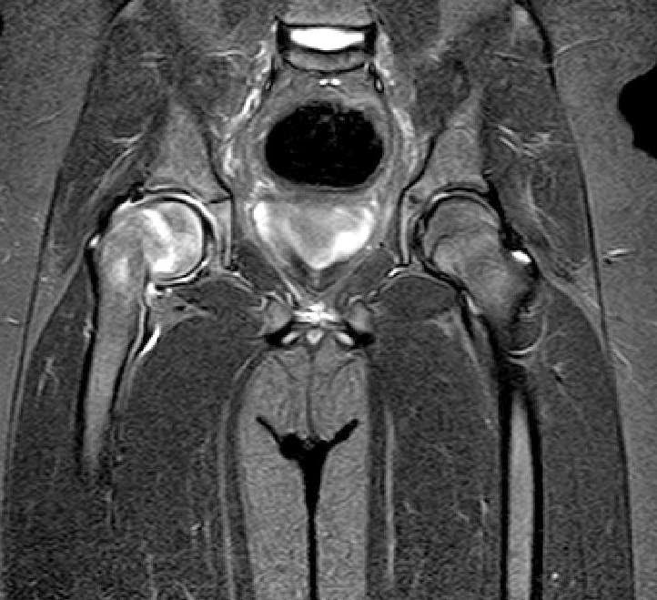 Slipped Upper Femoral Epiphysis-MRI - Sumer's Radiology Blog