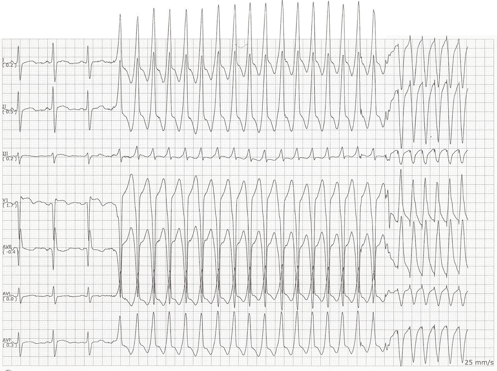 VT with Overdrive Pacing