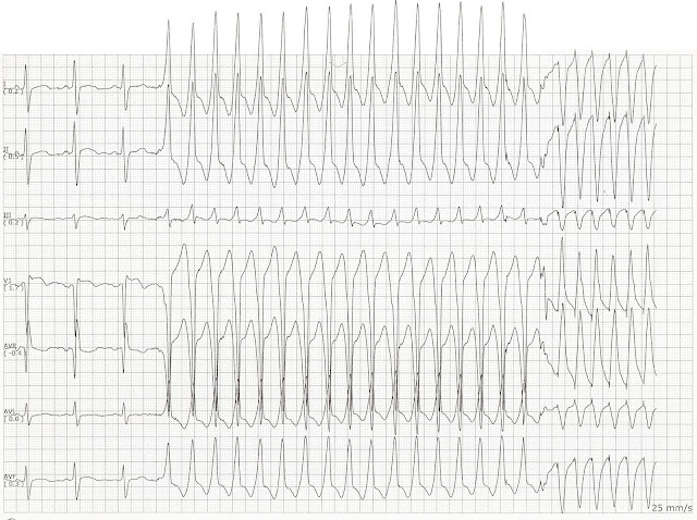 VT with Overdrive Pacing