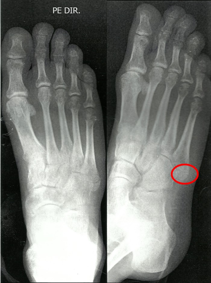 Iba Mendes: Fratura do 5º metatarso