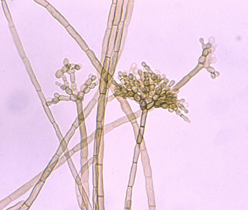 Um Convite à Biomedicina: Cromoblastomicose e suas relações clínicas