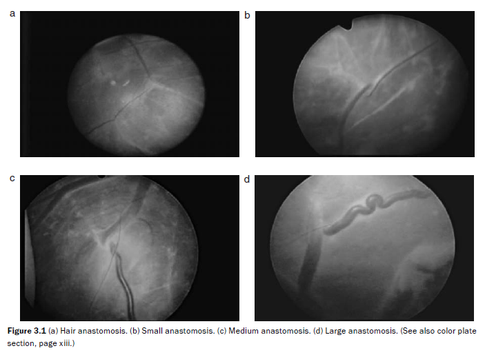 Obligatory etiology | Twin-Twin Transfusion Syndrome (TTTS)