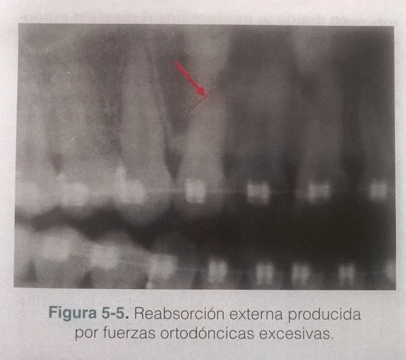 Tu Ortodoncia.: REABSORCION RADICULAR