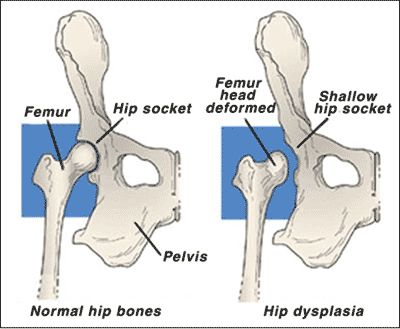 PHYSICAL THERAPY CORNER: "Developmental Hip Dysplasia of the Hip"- Issue 17