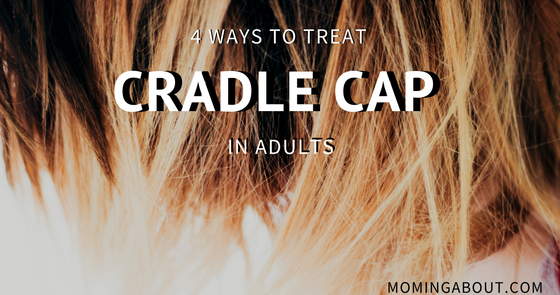 Moming About: 4 Ways to Treat Adult Cradle Cap (Scalp Psoriasis)