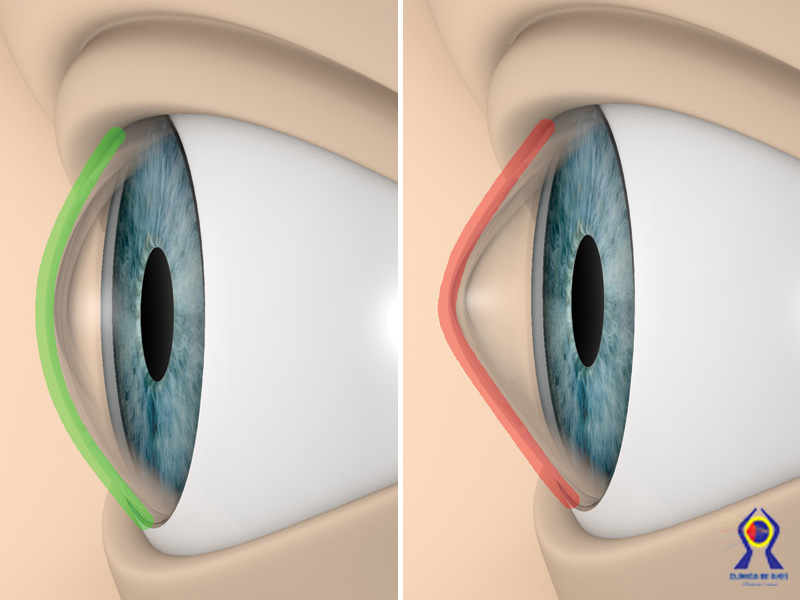 Clínica de Ojos Oftalmic Láser: EL QUERATOCONO