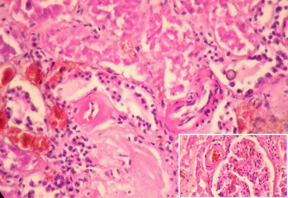 11. Hyalinosis arteriolarum renis | Pathology