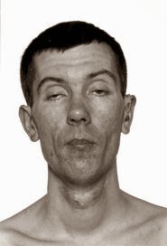 Medical Treatment Pictures-for Better Understanding: Kearns Sayre Syndrome