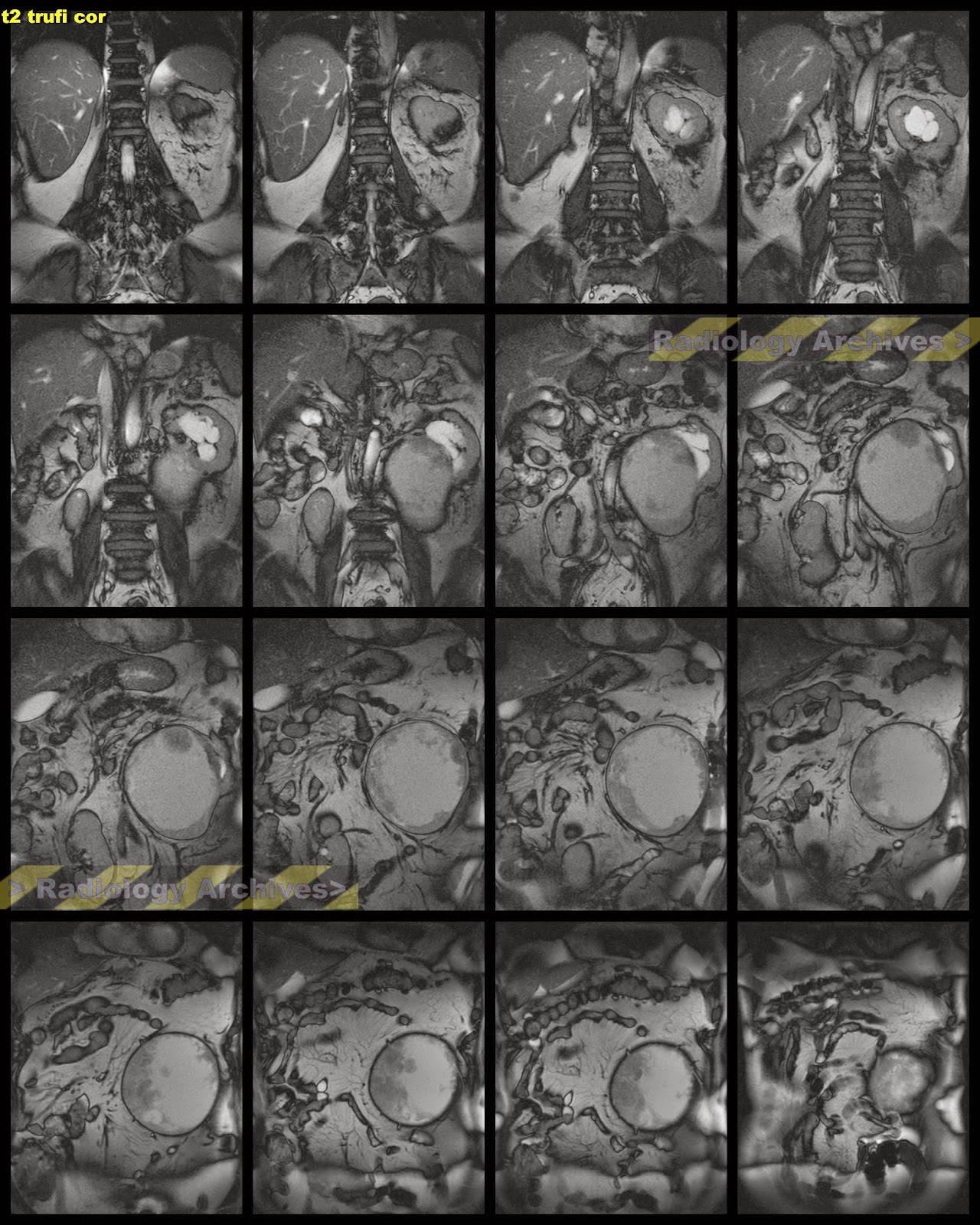 Radiology Archives: Καρκίνωμα εκ Νεφρικών Κυττάρων (Υπερνέφρωμα - Όγκος ...
