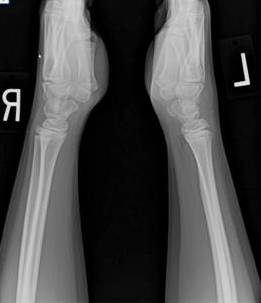 Os Radiale Externum -Plain film - Sumer's Radiology Blog