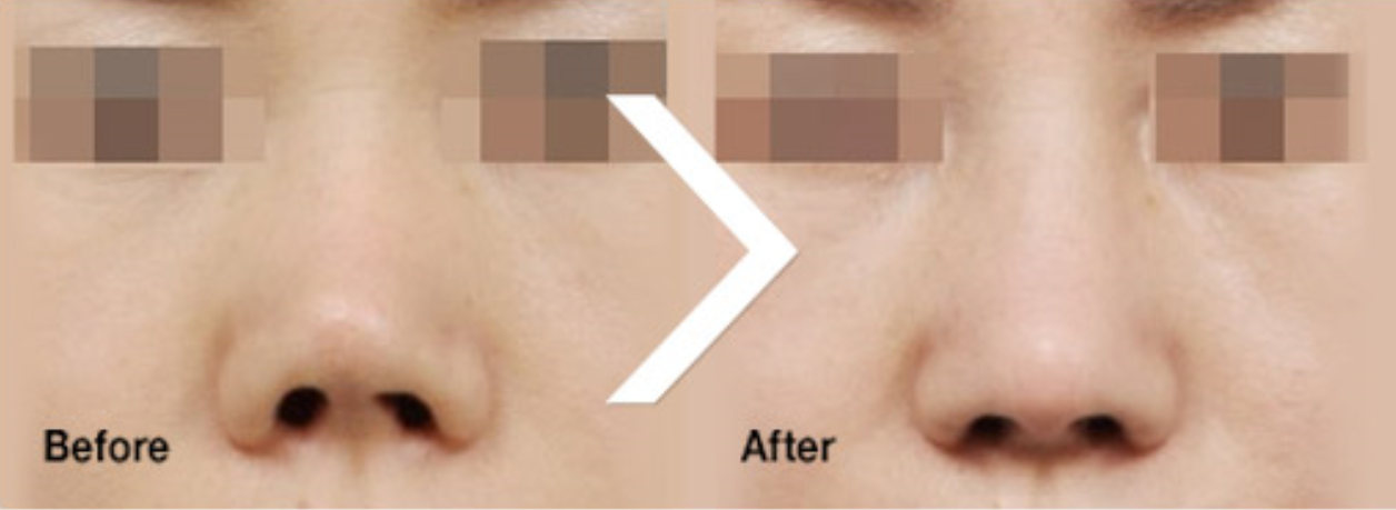 ID Hospital Korea: [ID hospital] What is nose revision?