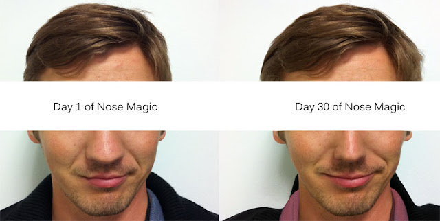 Nose Magic Before and After Pictures: Nose Magic Before and After - My ...