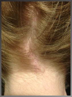 It's All In My Head - Life After a Brain Tumour: The After Effects of ...