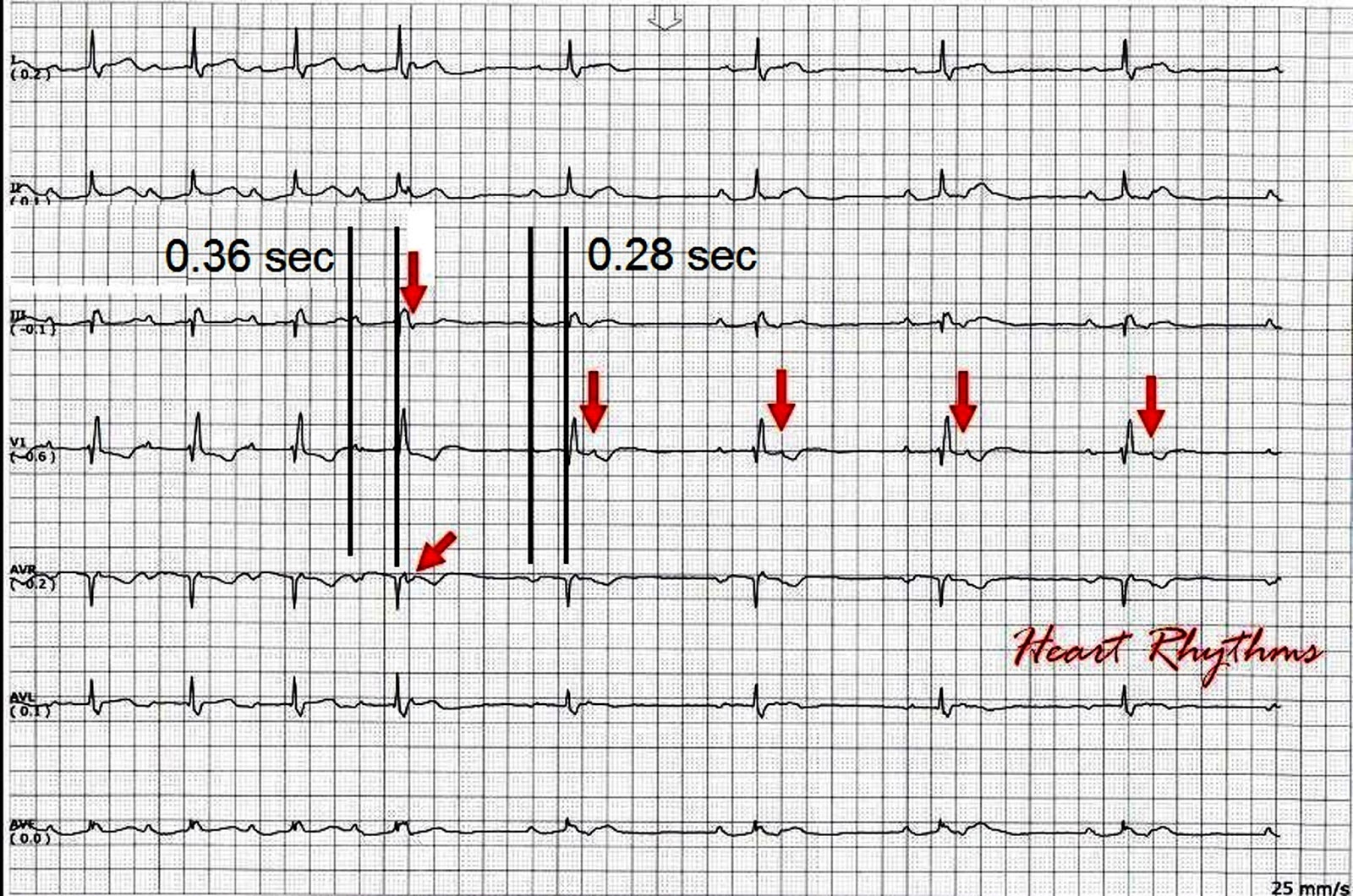 ECG Rhythms: Second degree AV block type I interrupted by nonconducted ...