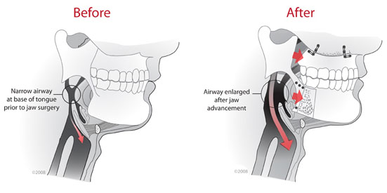 Mandibular Advancement Surgery - Treatment Cost and Recovery Time