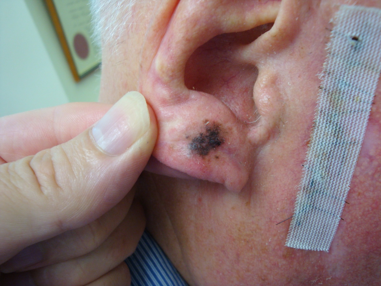 Dermpath Made Simple - Neoplastic: Lentigo Maligna