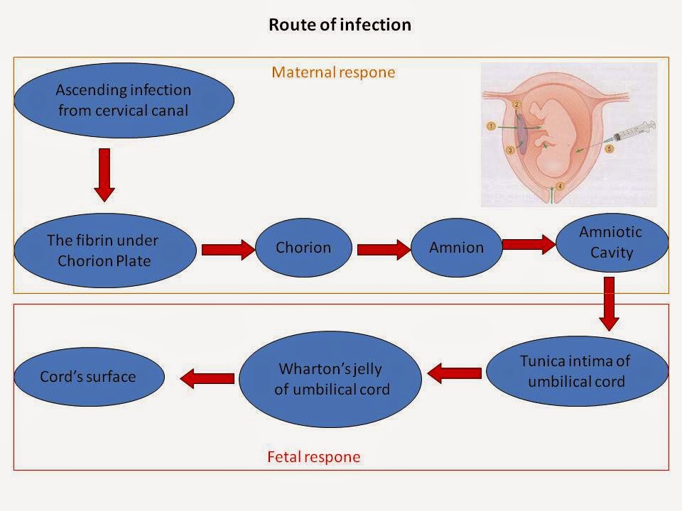 Reza Aditya Digambiro: Chorioamnionitis