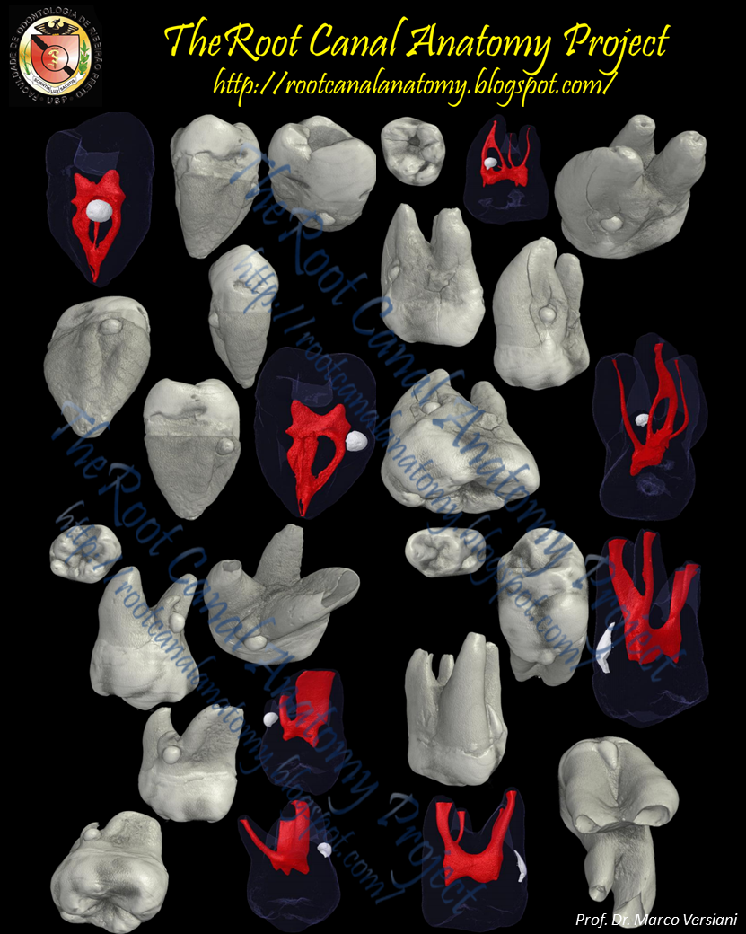 The Root Canal Anatomy Project: Enamel Pearls in Permanent Dentition