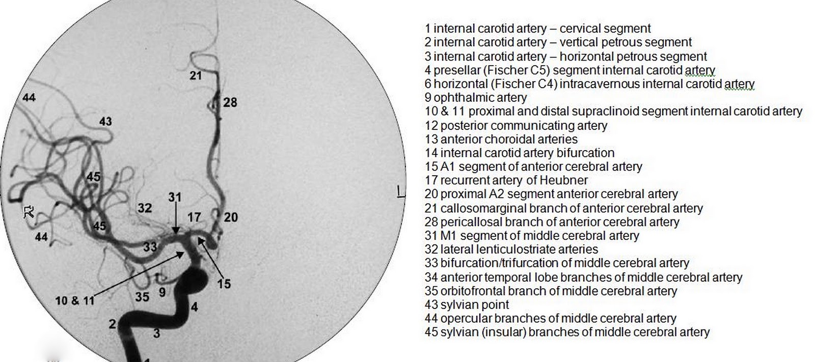 Doctor Man's Blog: 腦血管造影 (DSA cerebral angiogram)