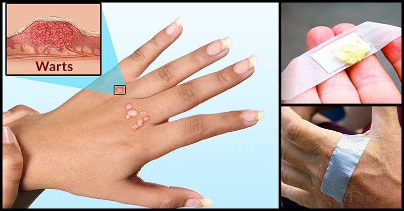 Effective Home Remedies For Tough Warts | Dr Farrah MD
