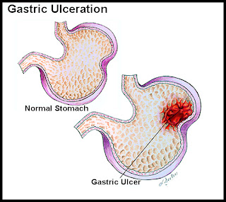 ULCER AND HEART BURN CONTROL TIPS