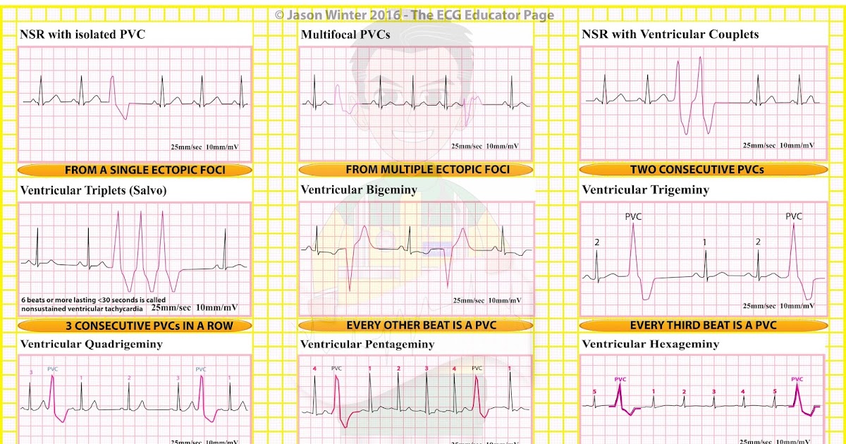 ECG Educator Blog : Ventricular Ectopics