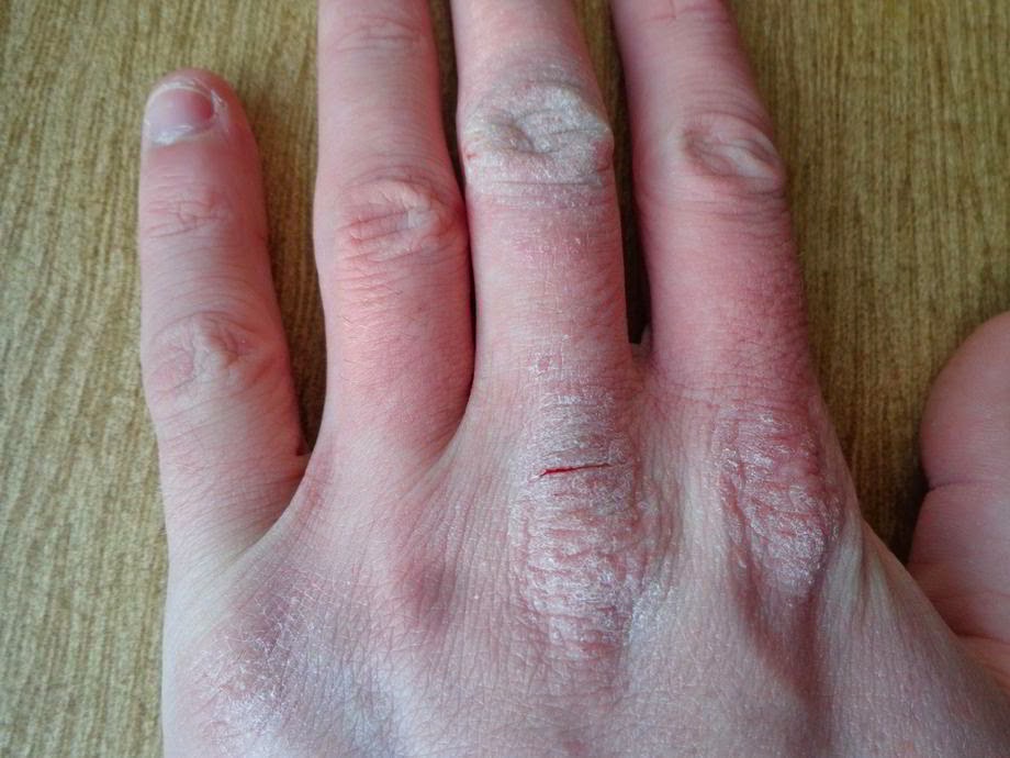 veneaa: 375- Atopowe zapalenie skóry