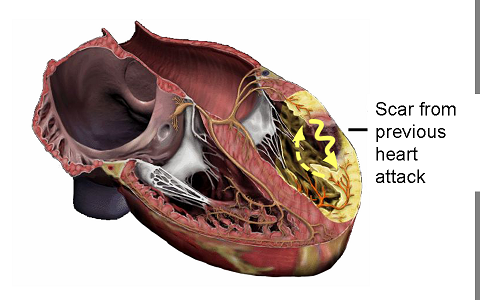HEALTH FROM TRUSTED SOURCES: Implantable cardioverter-defibrillators (ICDs)