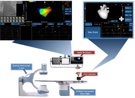 Easy to Use Navik 3D Cardiac Mapping System Cleared in U.S. ~ OUR ...