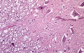 El Cerebro de Niños y Adolescentes: La Sustancia Blanca y la Sustancia ...