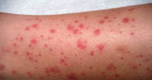 Study Medical Photos: Allergic Purpura - Clinical features And Management